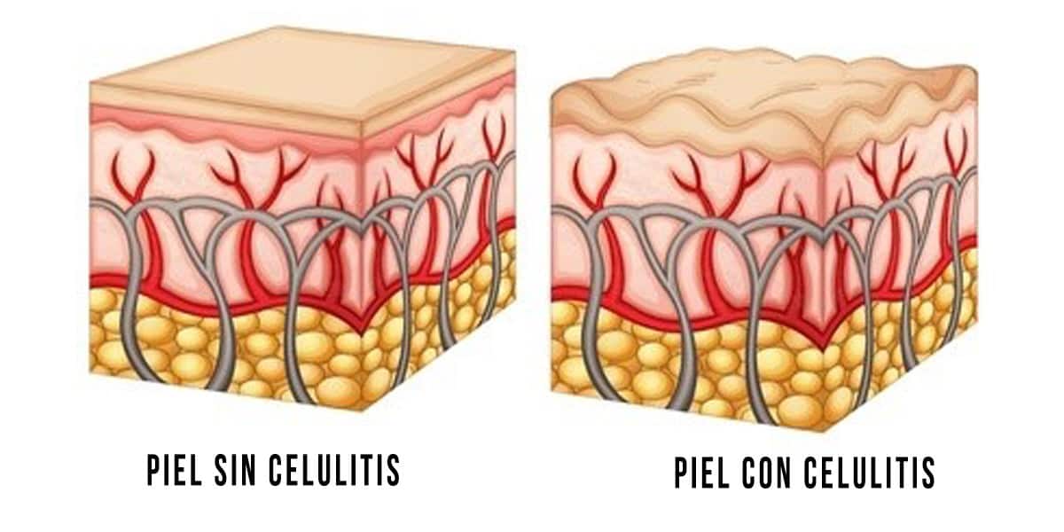 CELULITIS: Qué es, Tratamientos, Remedios, Cremas y Ejercicios